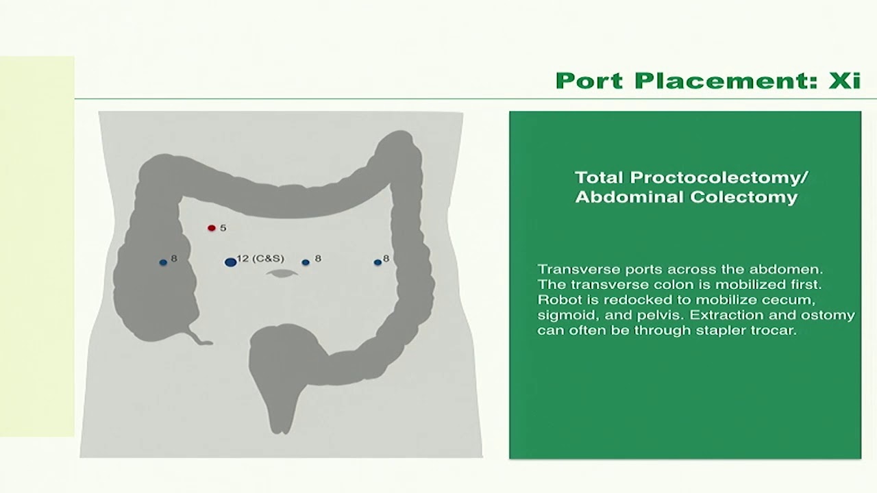 Chicago 2017 – Total Colectomy – Si And Xi | General Surgery Update