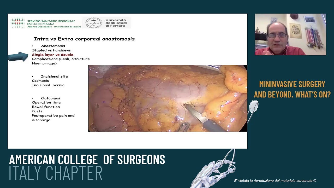 MINIMALLY INVASIVE RIGHT COLECTOMY: INTRA vs EXTRACORPOREAL ANASTOMOSIS | General Surgery Update